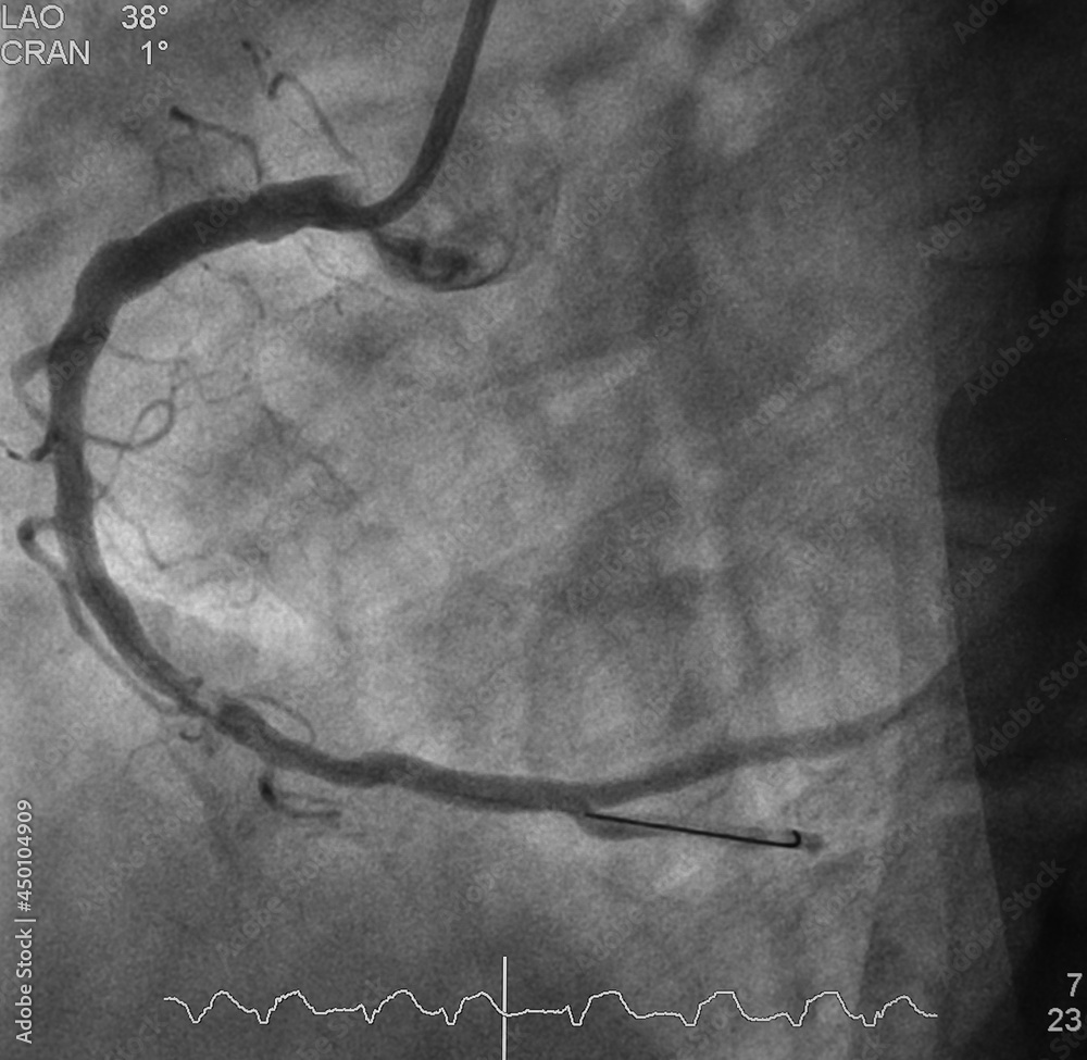 Coronary artery angiogram (CAG) of right coronary artery stenosis ...