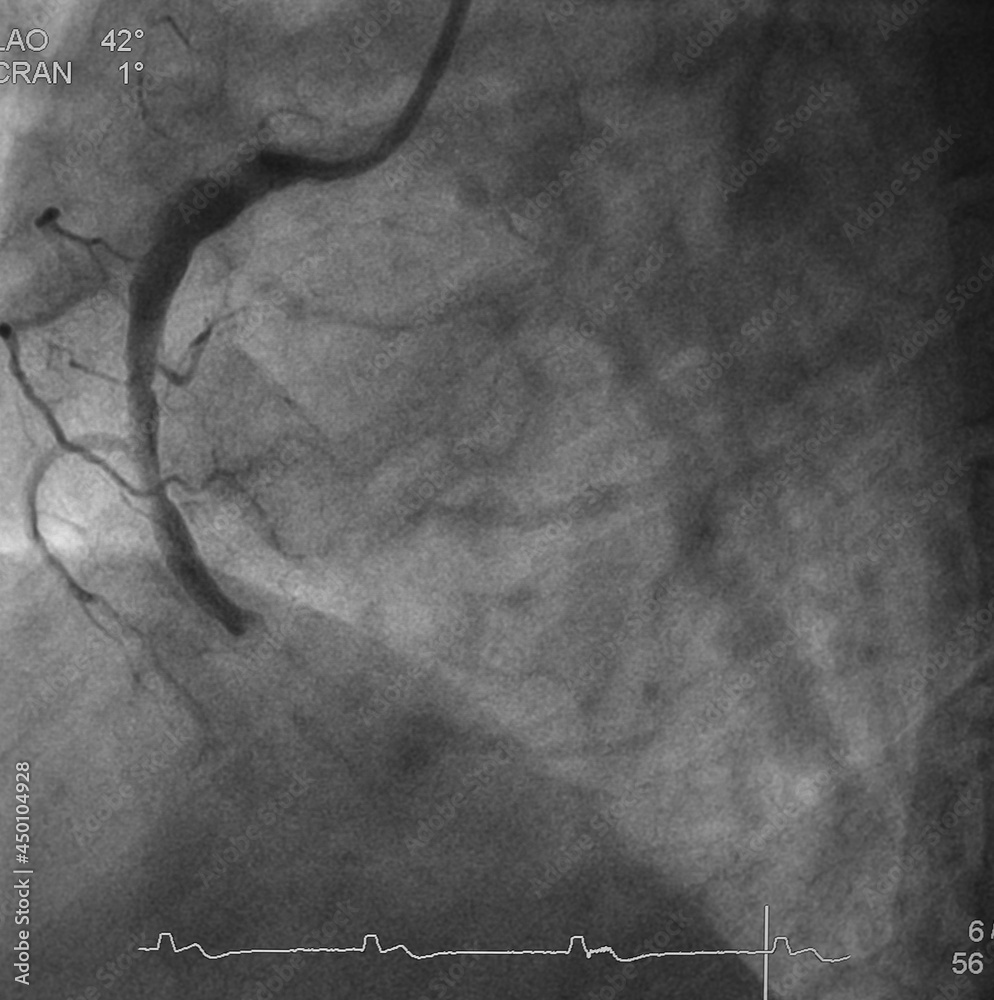 coronary angiogram was performed chronic total occlusion (cto) at mid ...