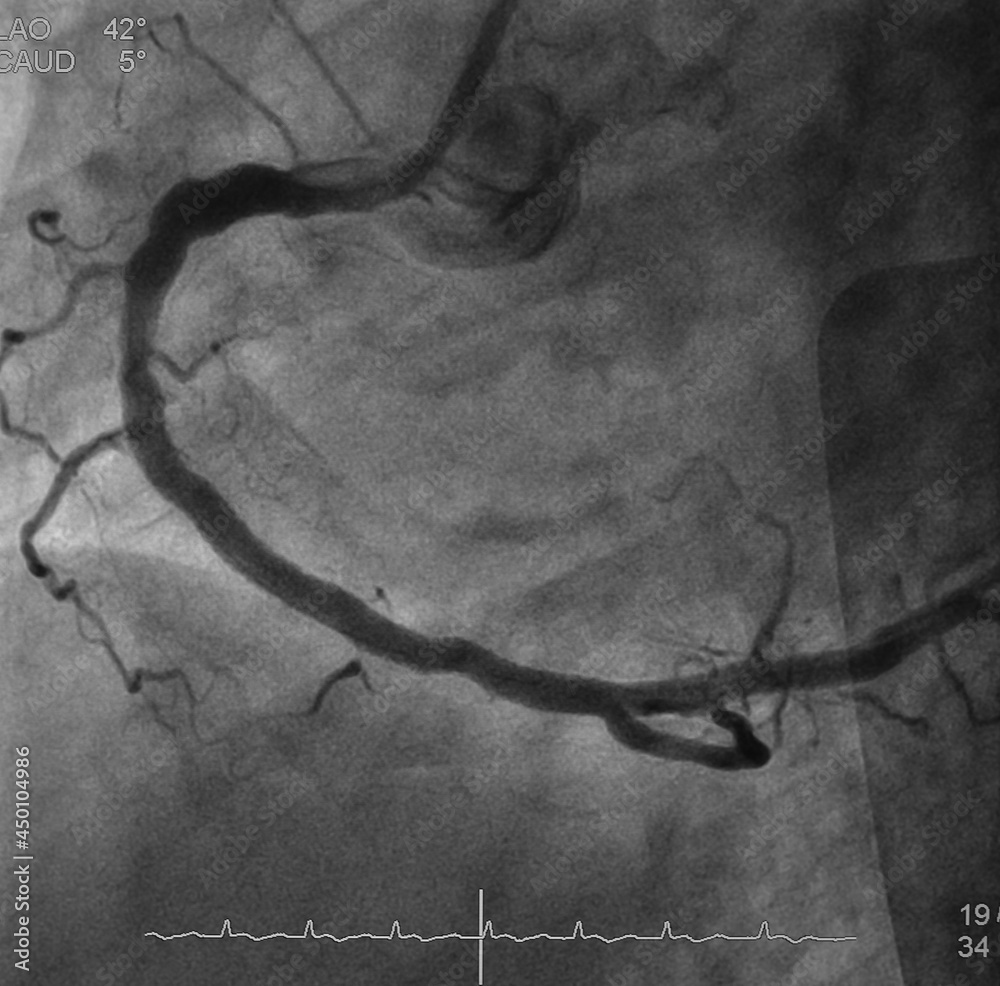 coronary artery angiogram (CAG) was performed normal right coronary ...