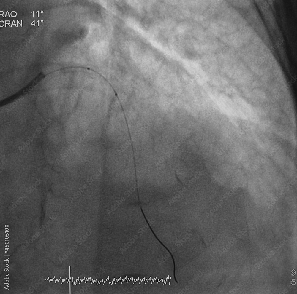 Coronary angiogram of balloon catheter inflation at proximal left ...