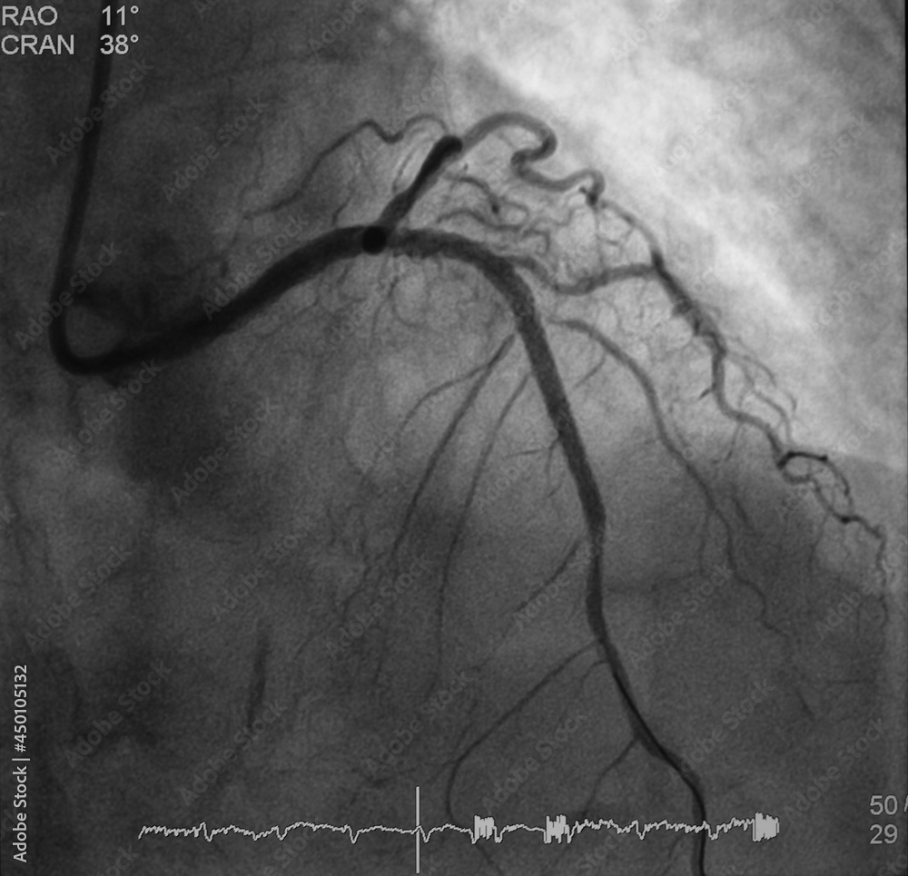 coronary angiogram (CAG) was performed post percutaneous coronary ...