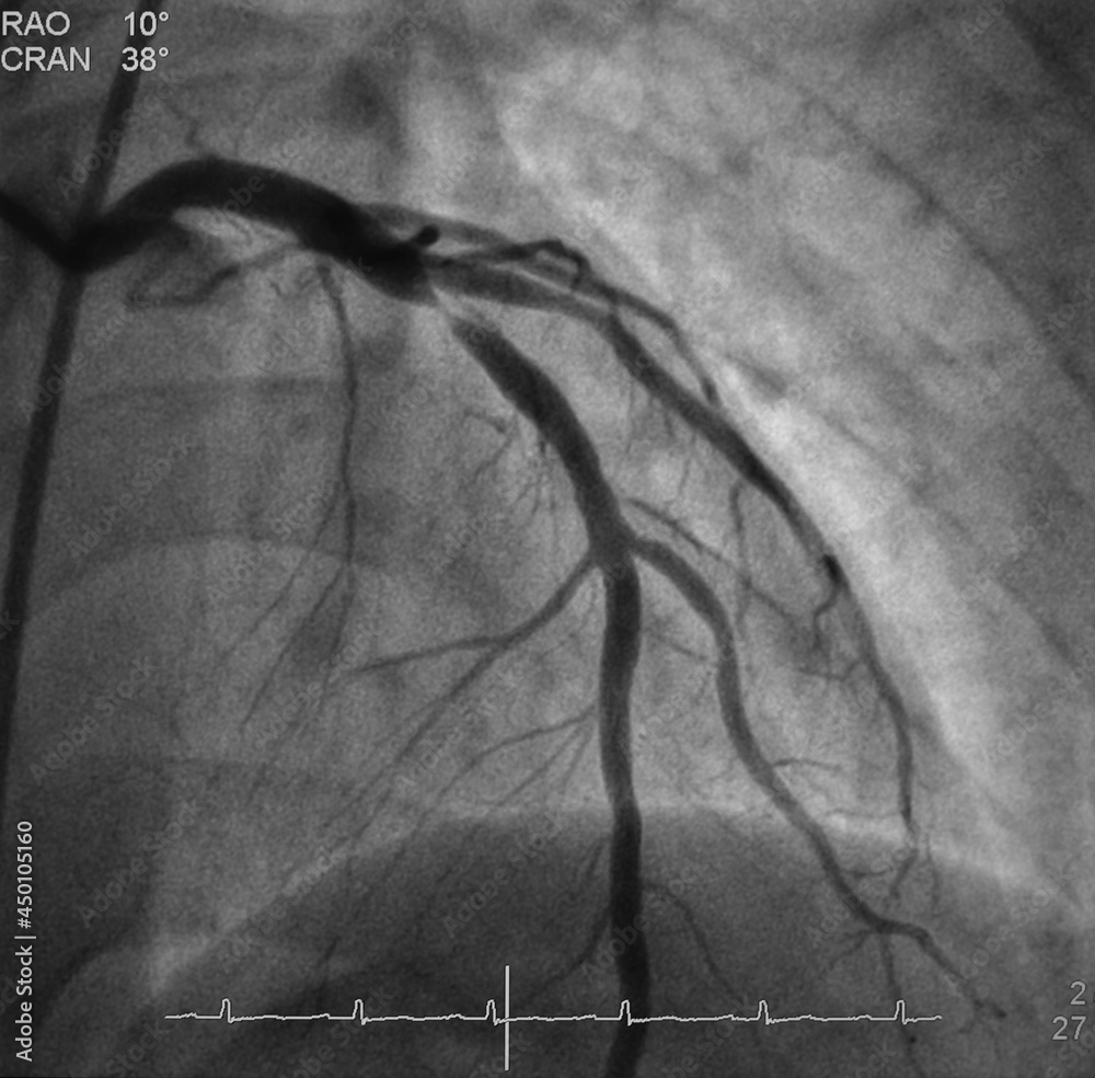 coronary angiogram(CAG) was performed left anterior descending (CAG ...