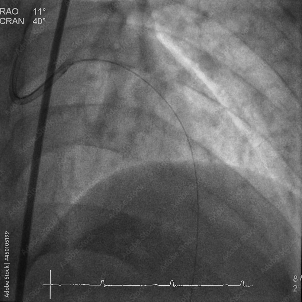 coronary angiogram (CAG) was performed post percutaneous coronary ...