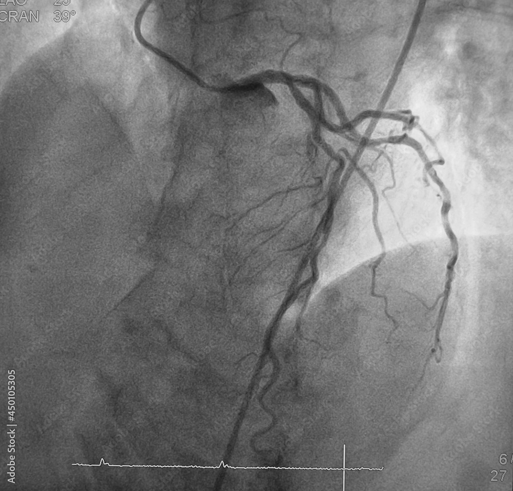 Foto de coronary angiogram (CAG) was showed left anterior descending ...