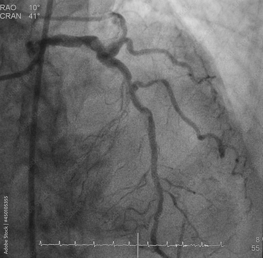 coronary angiogram (CAG) was showed left anterior descending artery ...