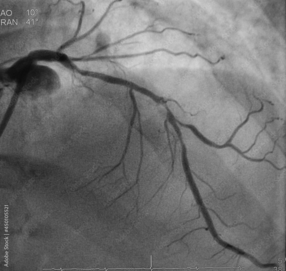 coronary angiogram (CAG) was performed mid part of left anterior ...