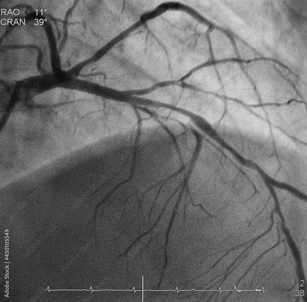 coronary angiogram (CAG) was showed left anterior descending artery ...
