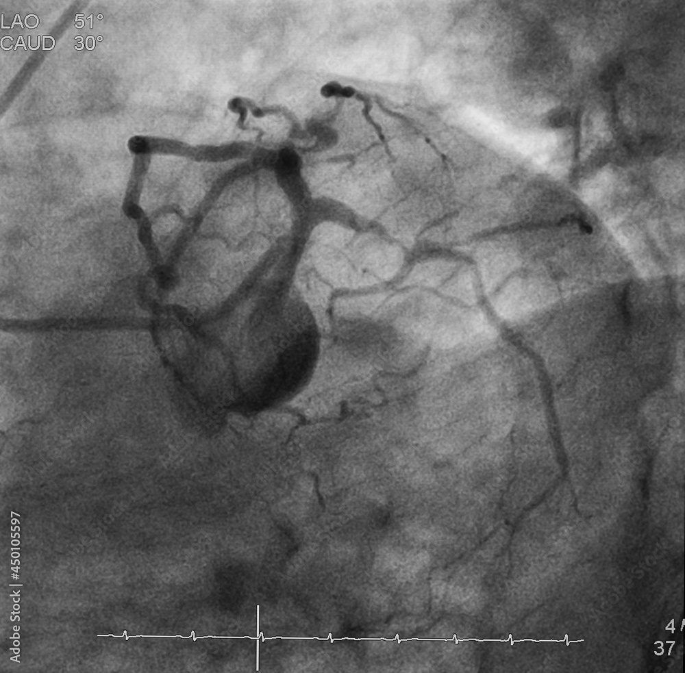 coronary angiogram (CAG) was performed left circumflex (lcx) stenosis ...