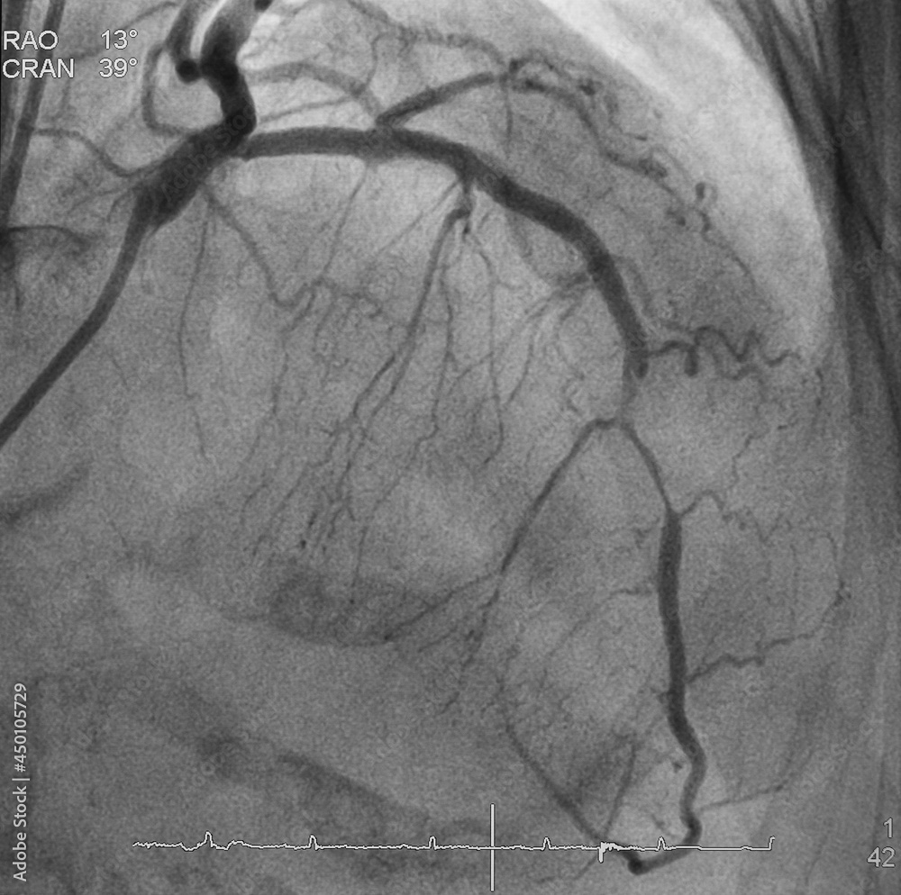 coronary angiogram (CAG) was performed distal part of left anterior ...