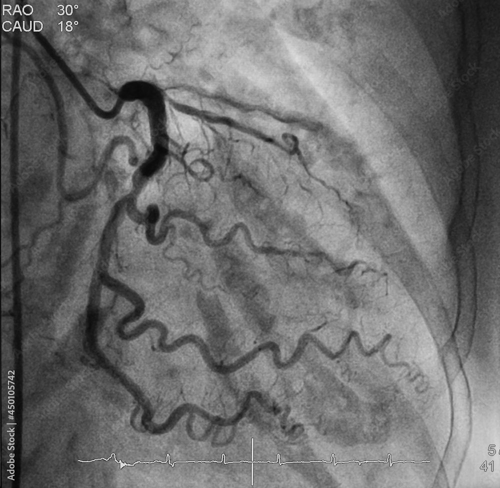 Coronary artery angiogram (CAG) of left coronary artery stenosis Stock ...