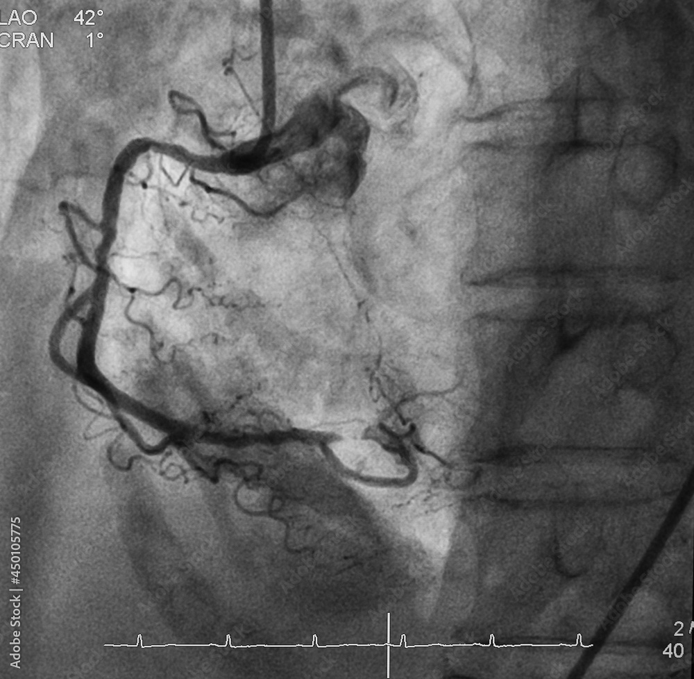 Coronary artery angiogram (CAG) of right coronary artery stenosis ...