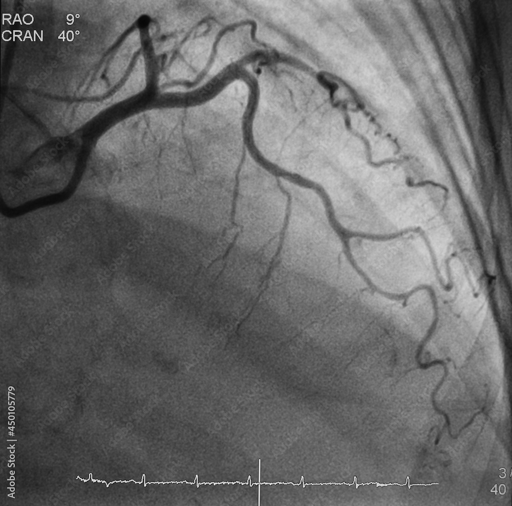 coronary angiogram (CAG) was performed normal left anterior descending ...