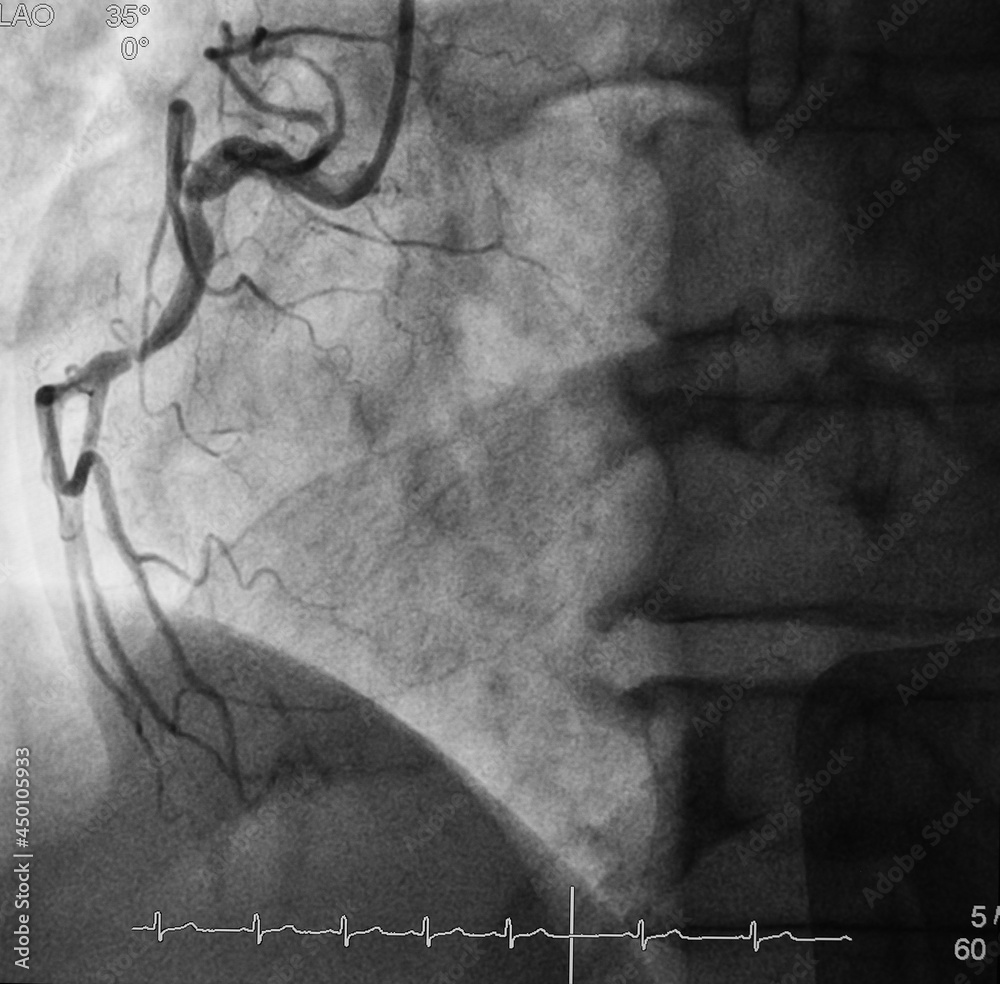 coronary angiogram was performed chronic total occlusion (cto) at mid ...
