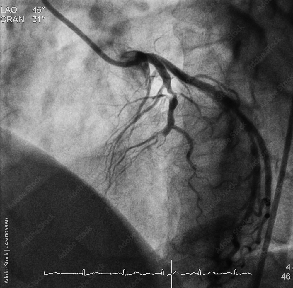 coronary angiogram (CAG) was showed chronic total occlusion (CTO) at ...