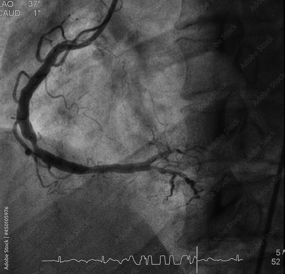 Coronary artery angiogram (CAG) of right coronary artery stenosis ...