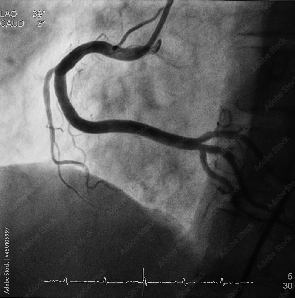 The coronary artery angiography (cag) was performed normal right ...