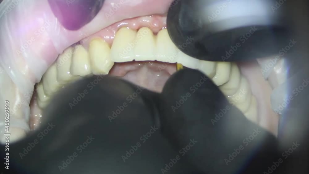 dentistry. shooting with a microscope. Installation of metal-plastic ...