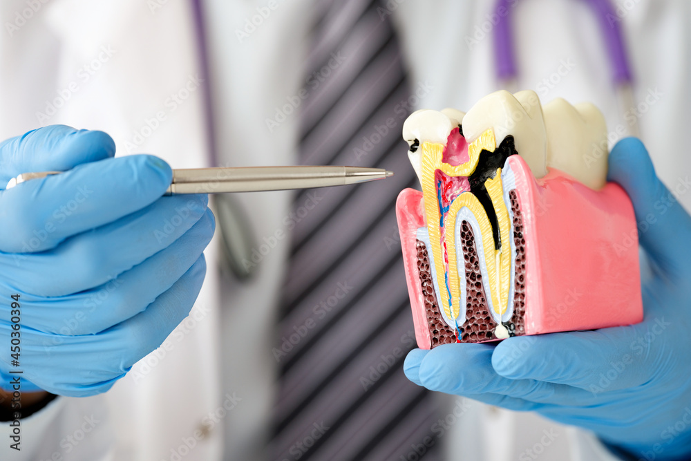 Dentist doctor showing with pen caries on dummy tooth closeup Stock ...