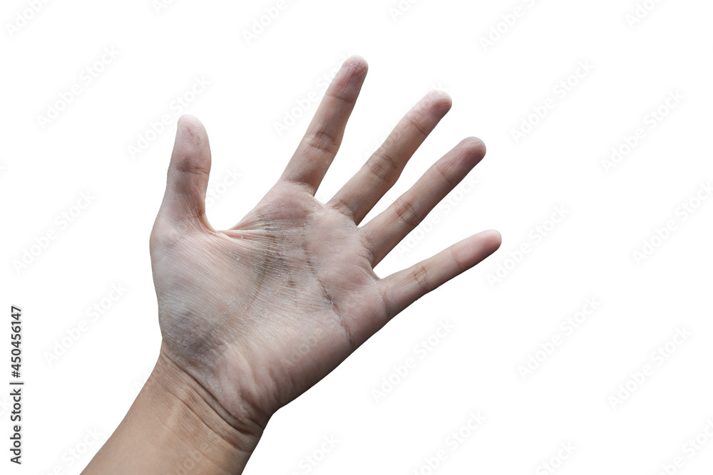 Dry cracked skin macro closeup of palm peeling of young woman's hand ...
