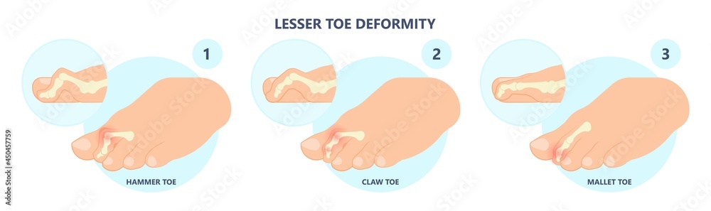 Plakat Hammer toe claw morton's hallux valgus curly turf bent joint ...