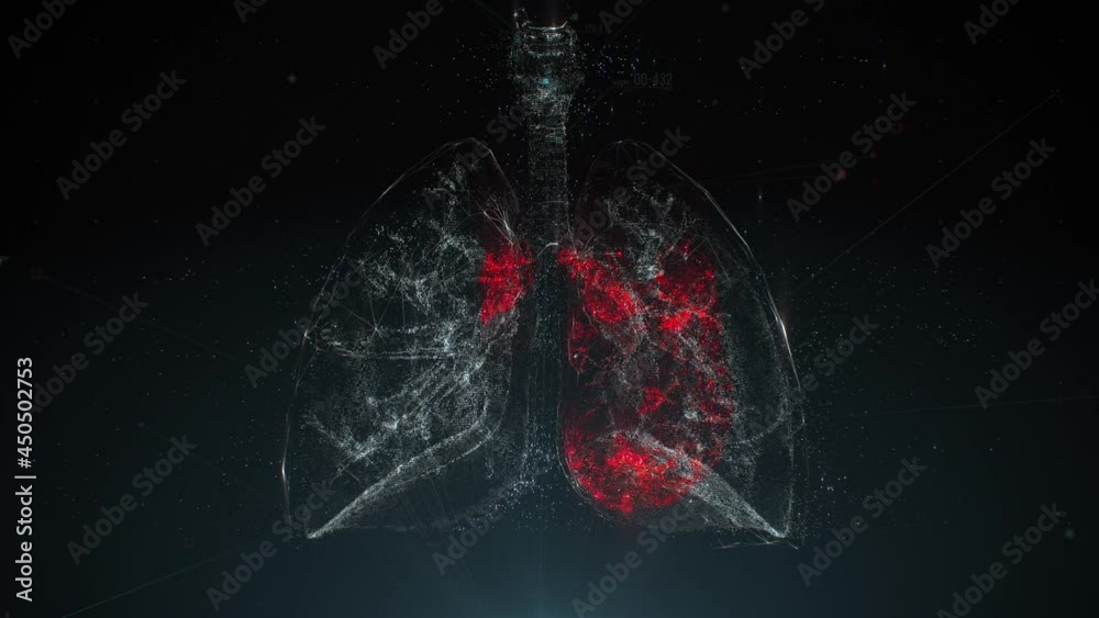 Respiratory system infection. Lung inflammation. Pneumonia Stock Video ...