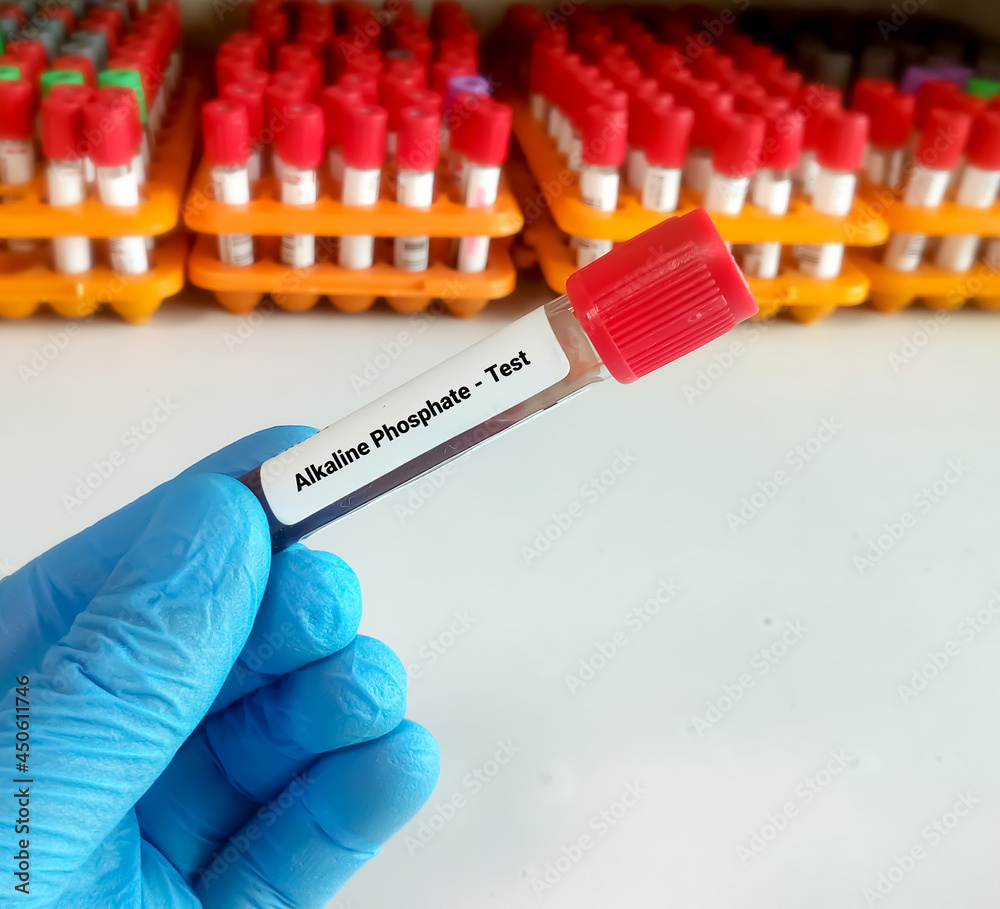 Stockfoto Blood sample tube for ALP or Alkaline Phosphatase enzyme test ...