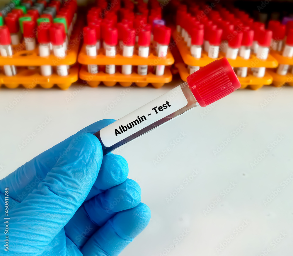 Blood sample tube for Albumin test. Diagnosis of liver disease ...