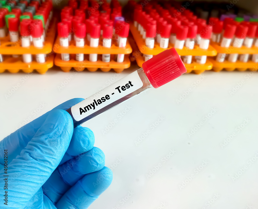 Blood sample for Amylase enzyme test. Biochemistry. Diagnosis of ...