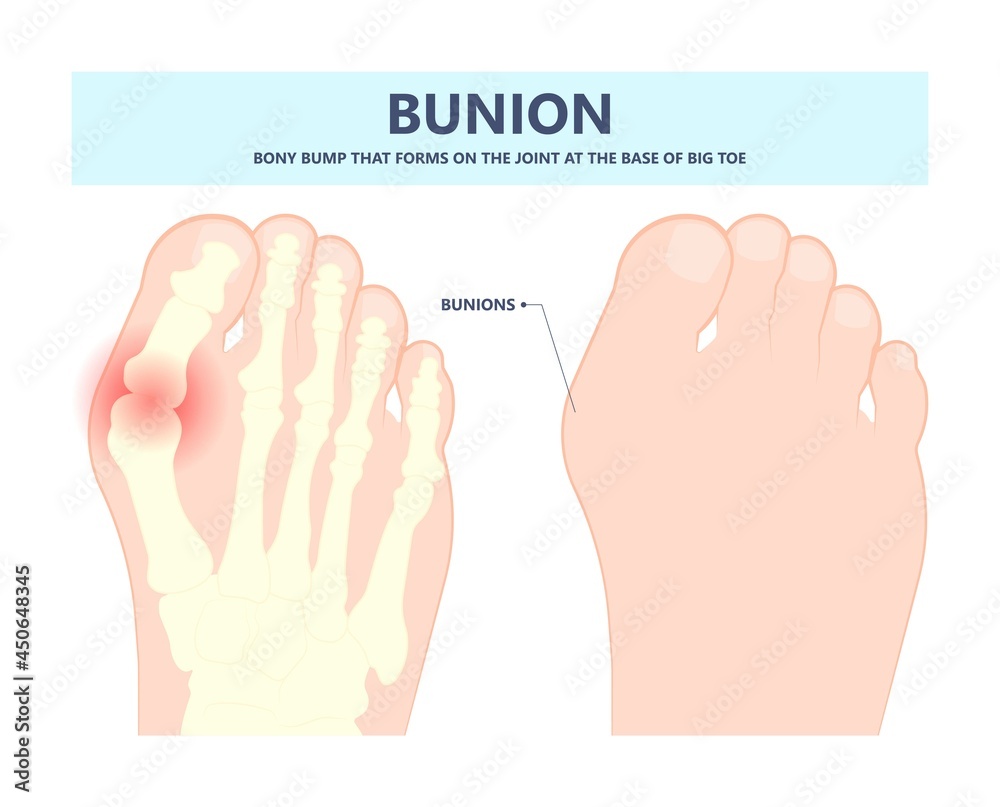 bony bump joint big toe bone enlarge fifth foot pain shoe Tailor ...