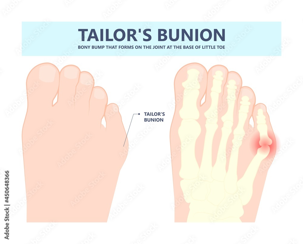 bony bump joint big toe bone enlarge fifth foot pain shoe Tailor ...