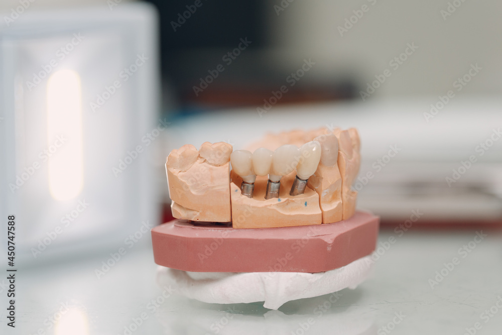 Dental layout of the human jaw with teeth and implants Stock Photo ...