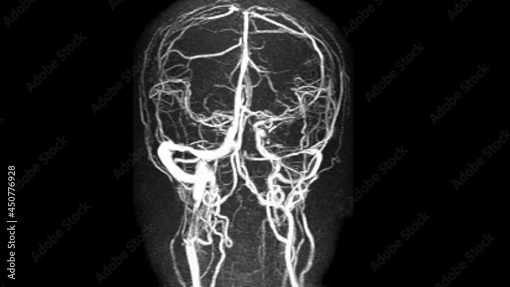 MRV Brain or magnetic resonance venography of The Brain for ...