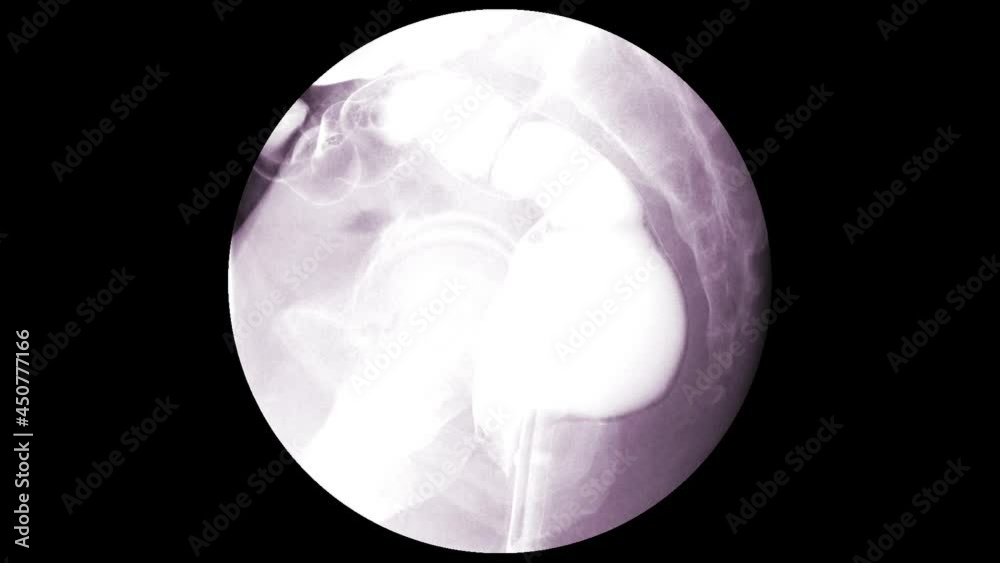 Barium enema image of large bowel after injection of barium contrast ...