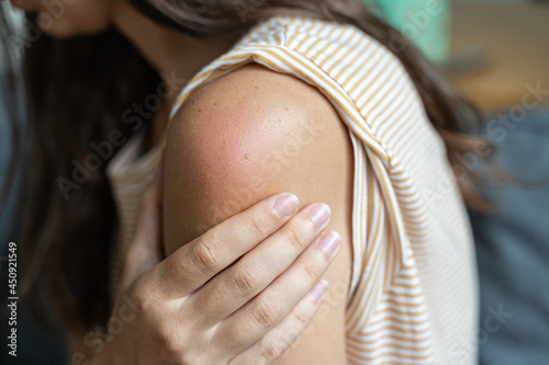 Side effect of the vaccine - shoulder skin redness and pain. Covid-19 ...