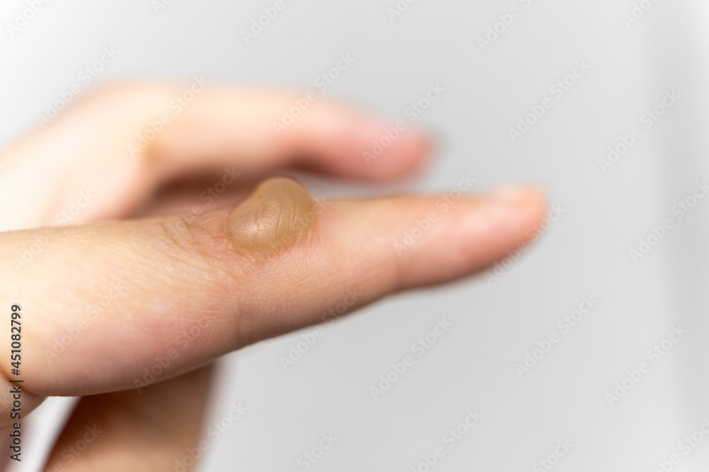 There is a blister on woman's hand from a burn. Burn of the finger. A ...