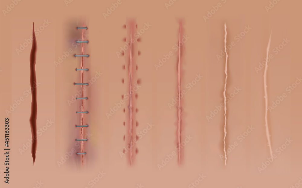 Set of healing wounds, skin scars, stitched gash and cuts. Realistic ...