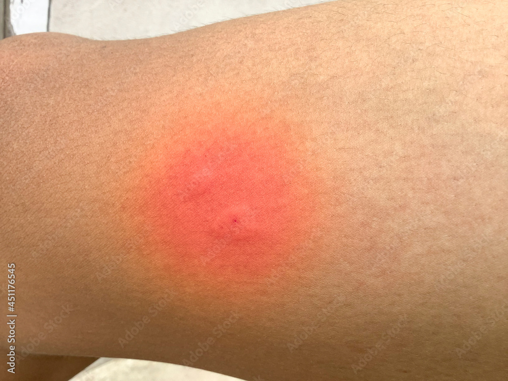 Human skin was stung by poisonous insects. Stock Photo | Adobe Stock