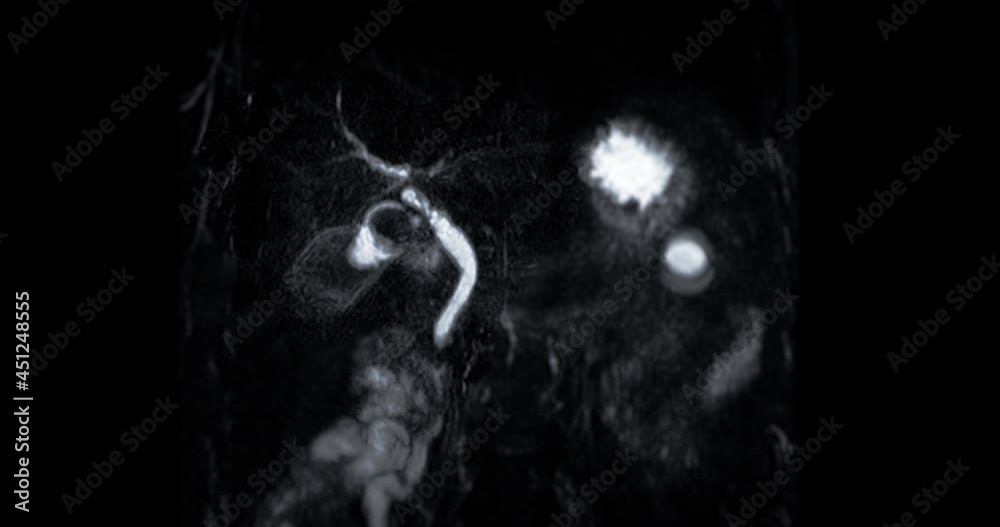 MRCP or Magnetic resonance cholangiopancreatography Coronal MIP showing ...