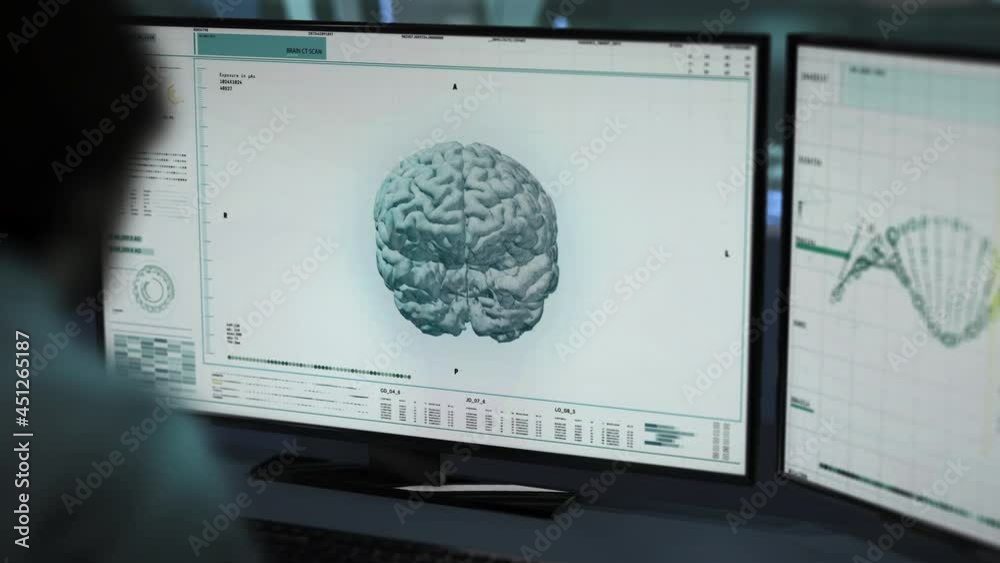 Doctor Looks At Brain Diagnostic Screen To Localise Brain Tumor. Brain ...