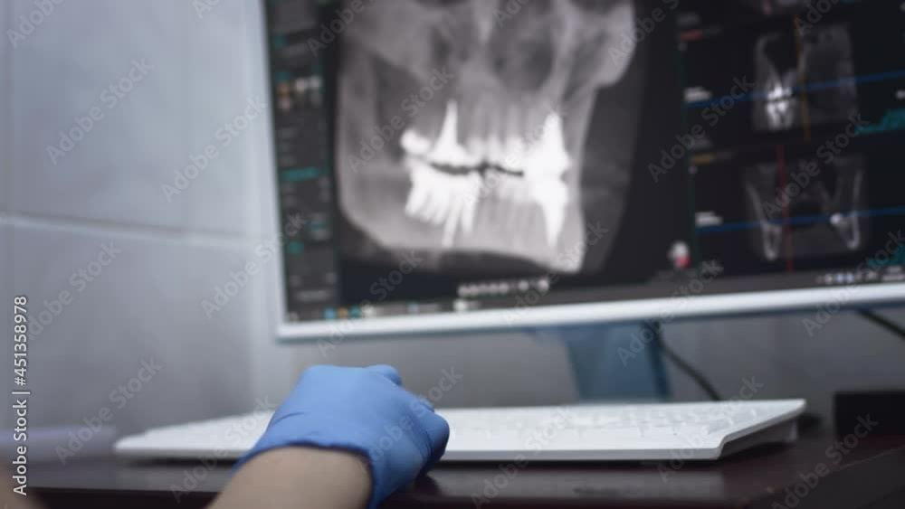 Dentist doctor examines a panoramic x-ray of the jaw on a computer ...