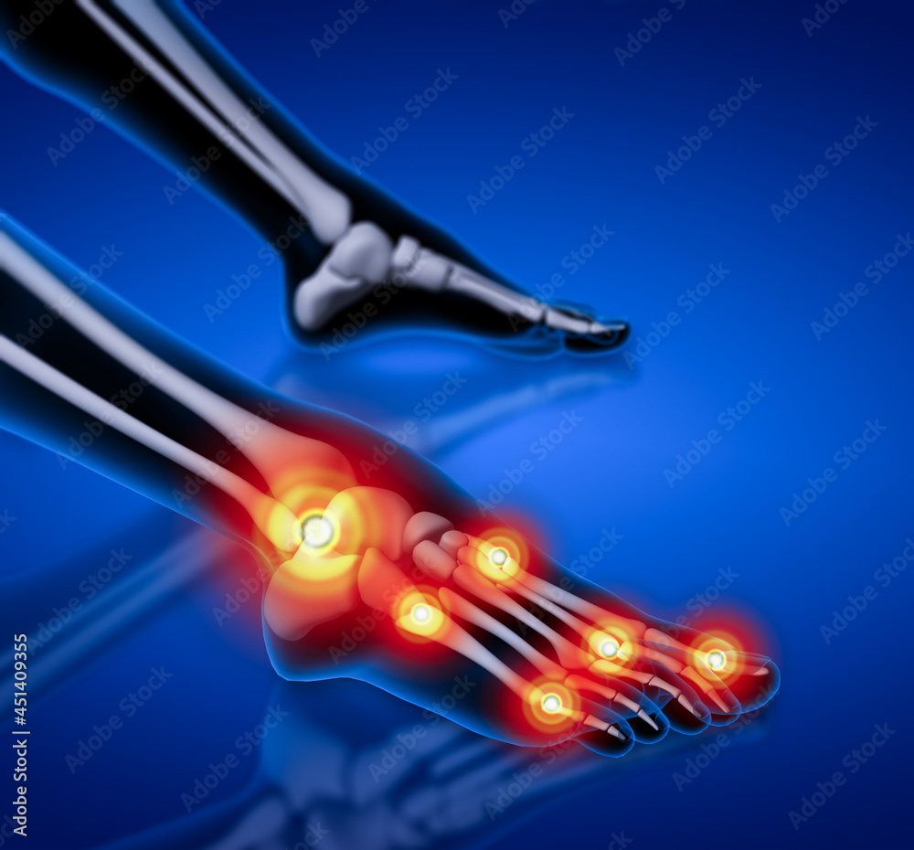 Human foot pain with the anatomy of a skeleton foot Stock Illustration ...