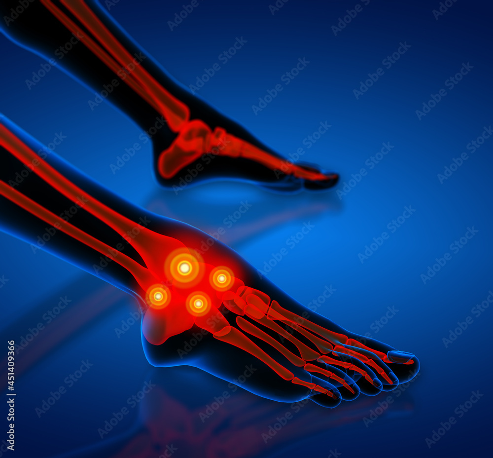 Human foot pain with the anatomy of a skeleton foot Stock Illustration ...