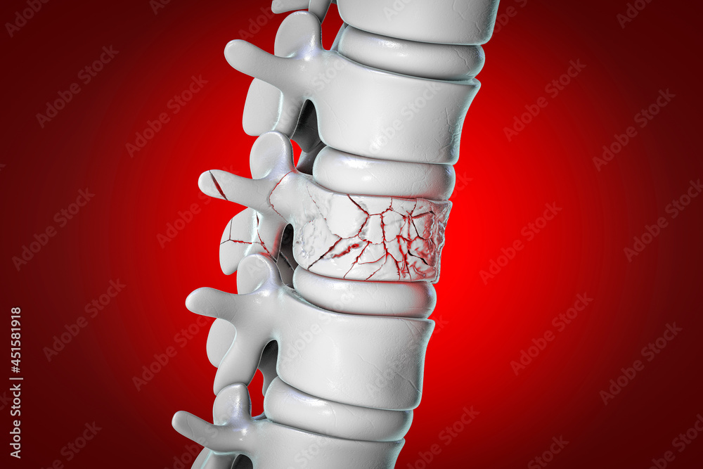 Spinal fracture, traumatic vertebral injury Stock Illustration | Adobe ...