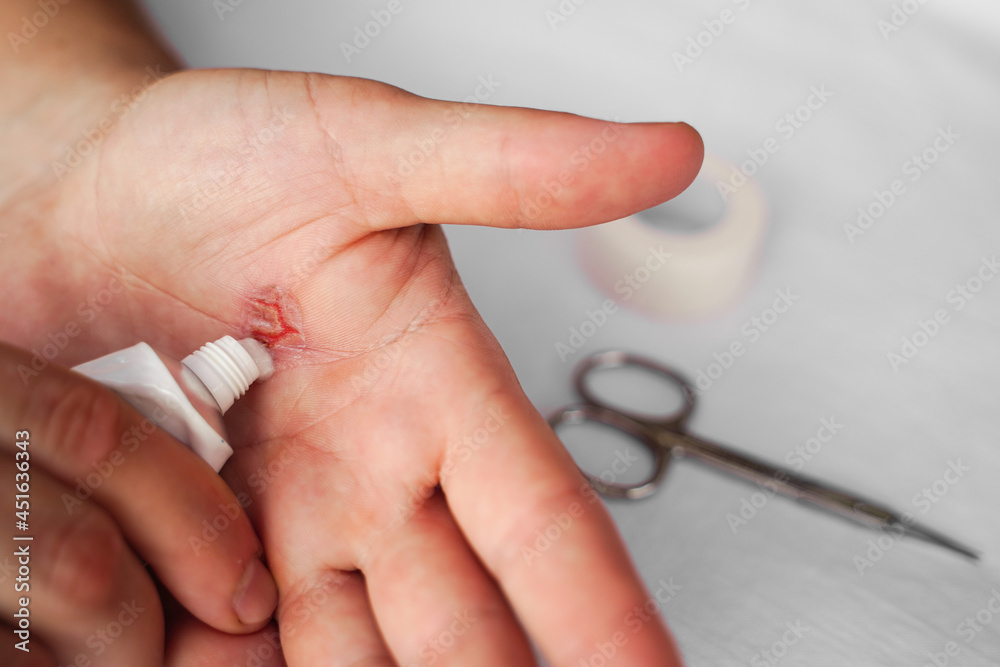 A large corn on the palm of a man. Medical concept. Applying a healing ...