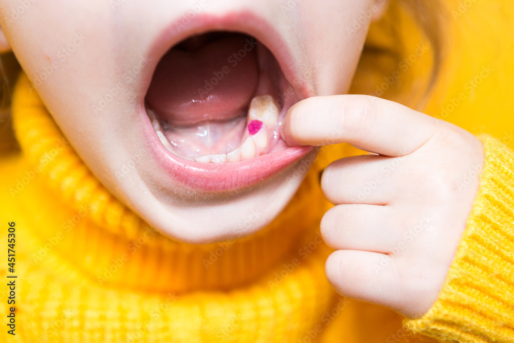 Colored purple filling on the girl's milk chewing tooth. Pediatric ...