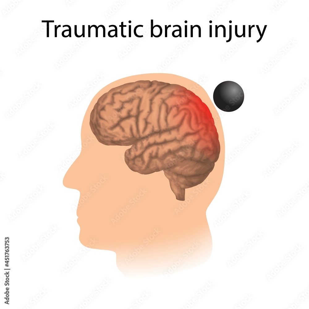 Traumatic brain injury, illustration Stock Illustration | Adobe Stock