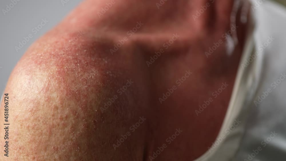 Extreme closeup of woman showing shoulder with skin rash hives. Shown ...