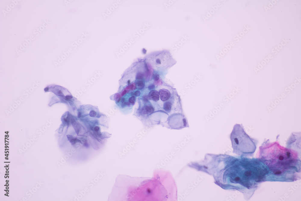 View in microscopic of Abnormal human cervix cells.Squamous epithelium ...