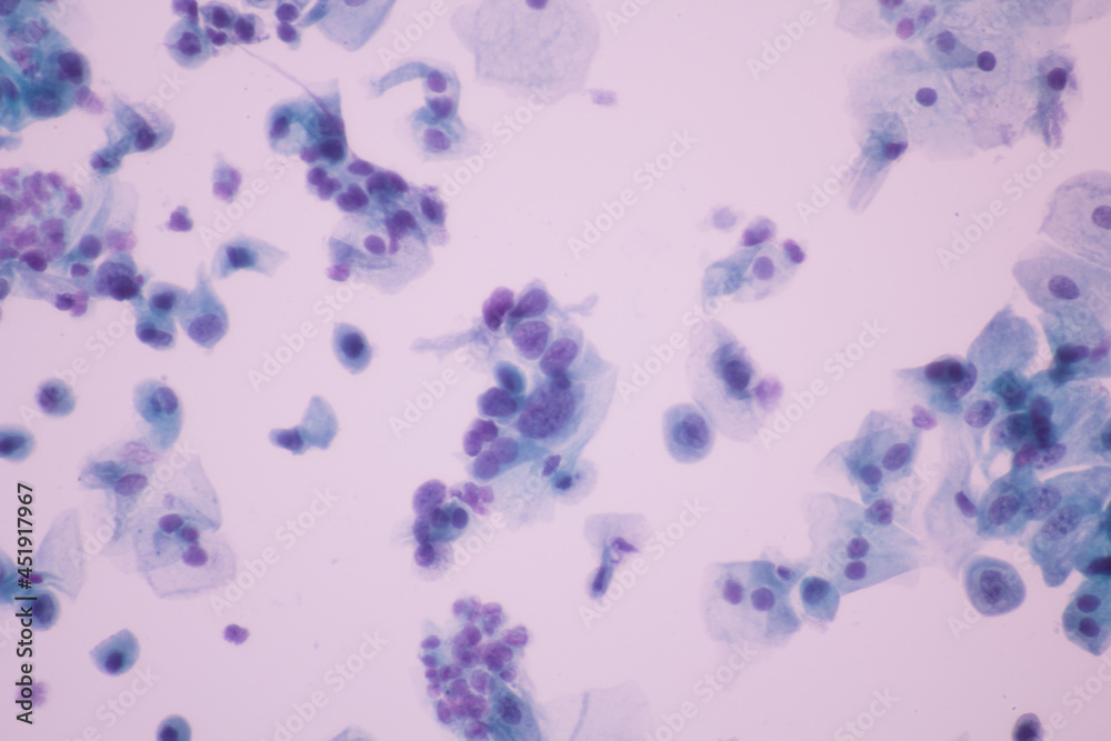 View in microscopic of Abnormal human cervix cells.Squamous epithelium ...