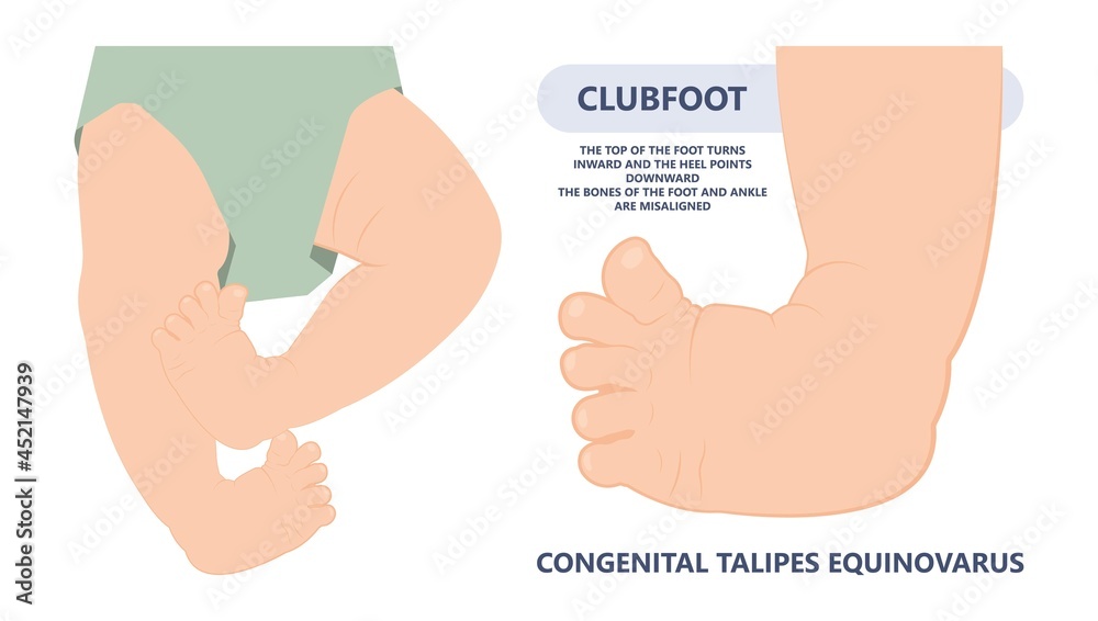Newborn Foot Turned Inward at Micheal Weston blog